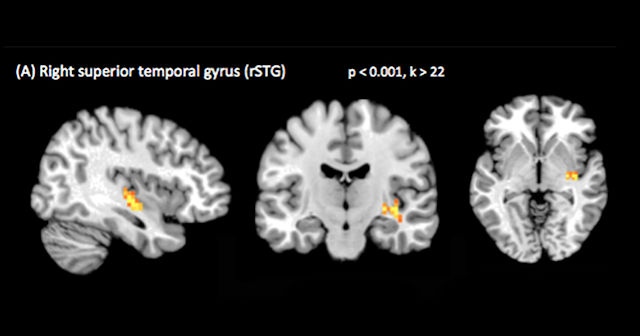 Altered Cortical And Subcortical Connectivity Due To Infrasound